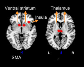 CBD effects on psychosis